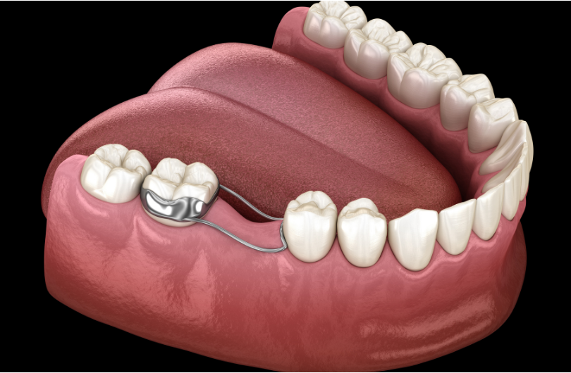 Braces | First Impressions Orthodontics